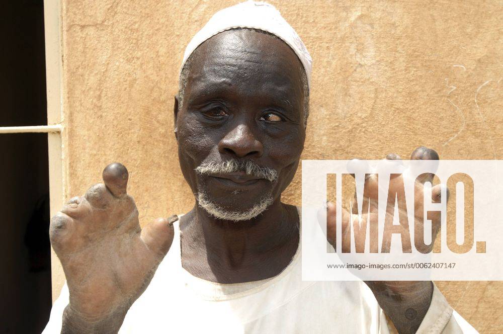 Leprosy Hands New Report By COPH Researchers Outlines Effort To